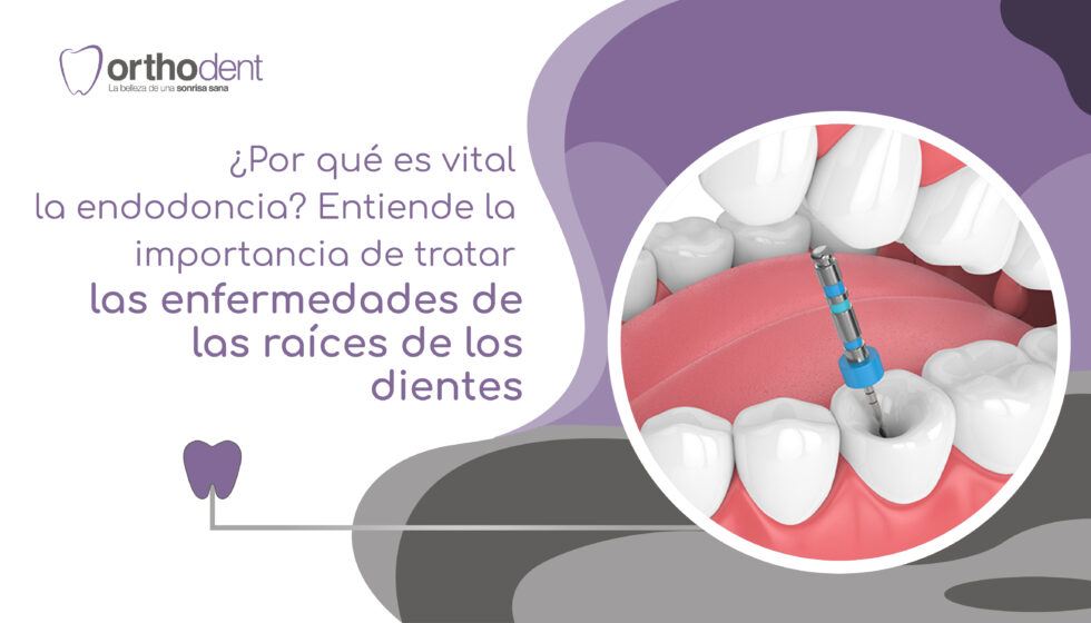 ¿Por qué es vital la endodoncia? Entiende la importancia de tratar las ...