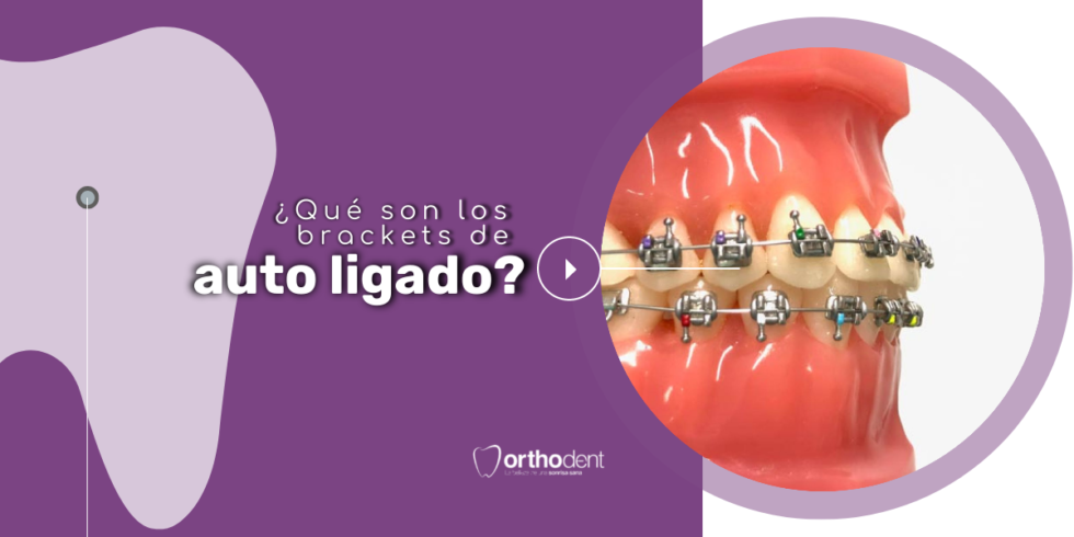 ¿Qué son los brackets de autoligado y cómo difieren de los brackets ...