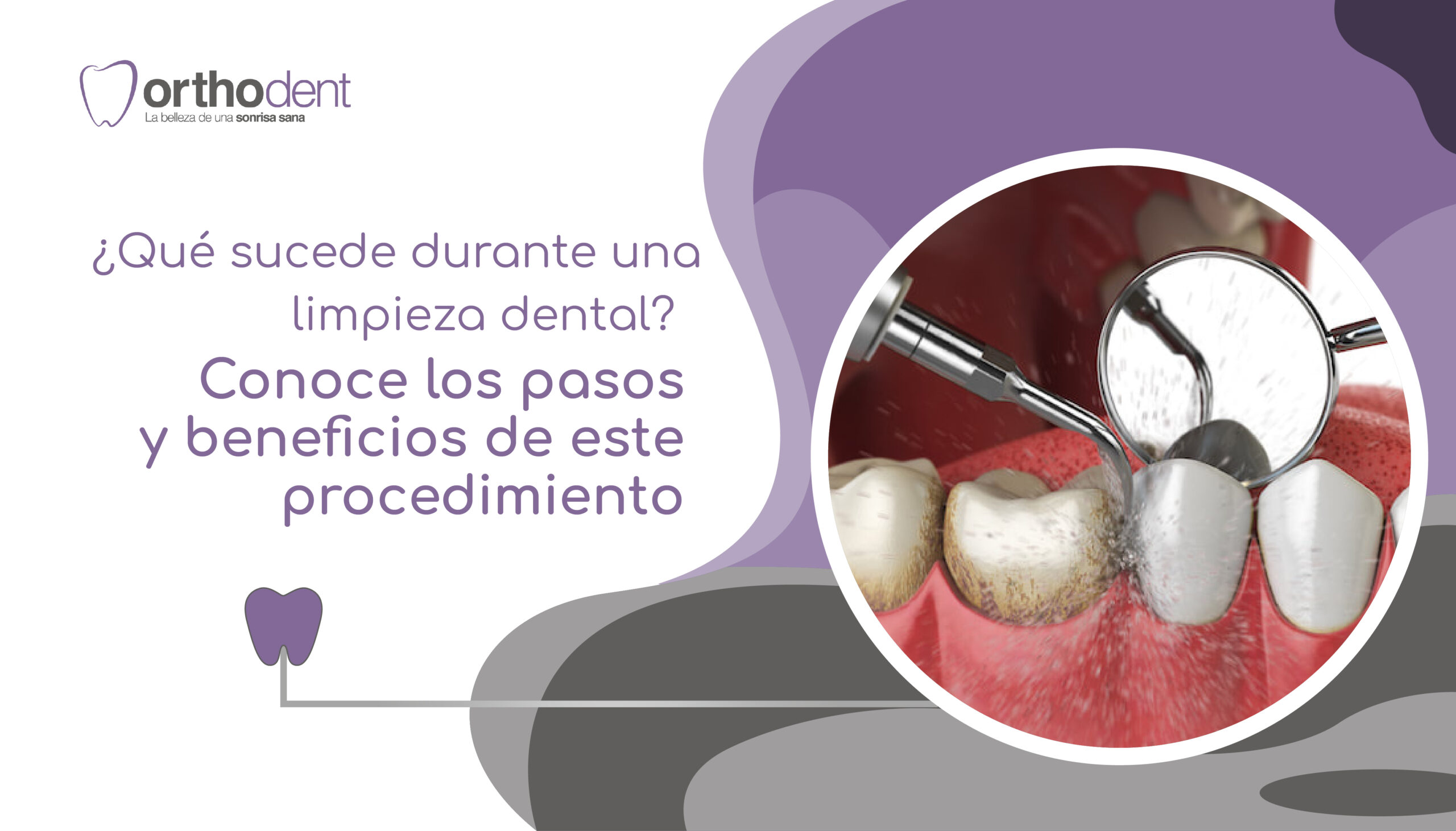 ¿Qué sucede durante una limpieza dental? Conoce los pasos y beneficios ...