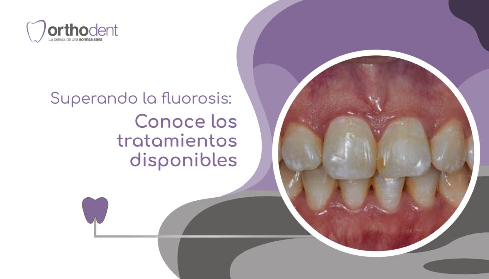 Superando la fluorosis: Conoce los tratamientos disponibles - Orthodent
